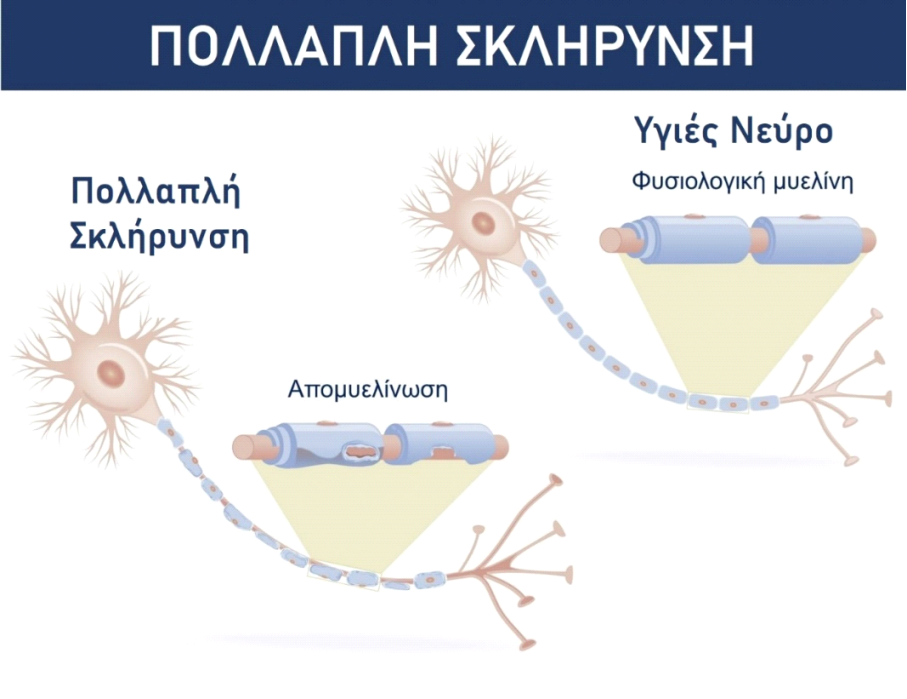 Παθήσεις - ΠΡΟΗΓΜΕΝΗ ΦΥΣΙΚΟΘΕΡΑΠΕΙΑ ΜΑΥΡΟΠΑΝΟΣ